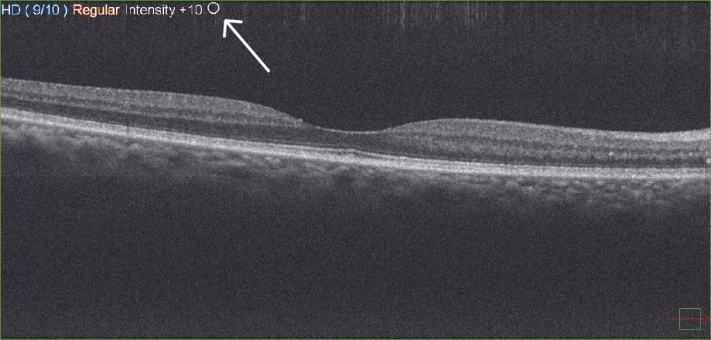 Tomógrafo de Coherencia Óptica (OCT) RS-330 Retina Scan Duo 2 - NIDEK